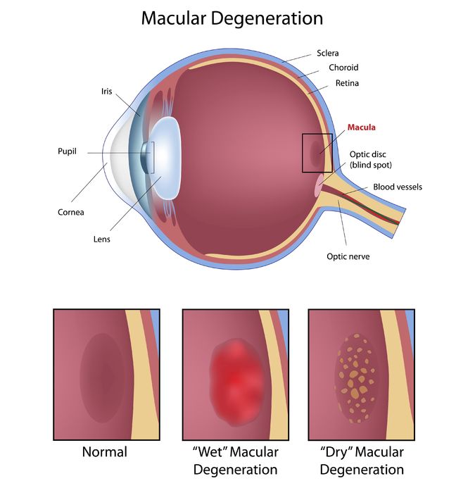 Altersabh ngigen Maculadegeneration AMD ApothekenWiki Altersabh ngigen Maculadegeneration AMD ApothekenWiki